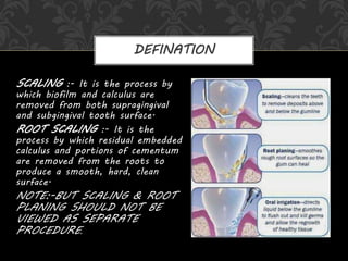 LxScaling and root planing | PPTX