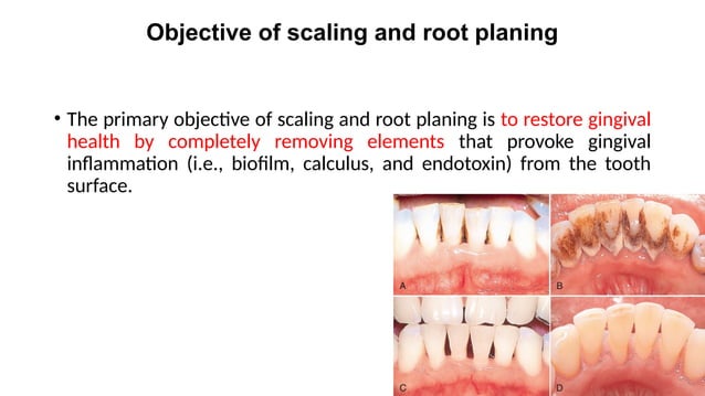 scaling and root planning lecture(1).pptx