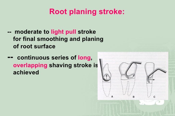 Root Planing And Scaling