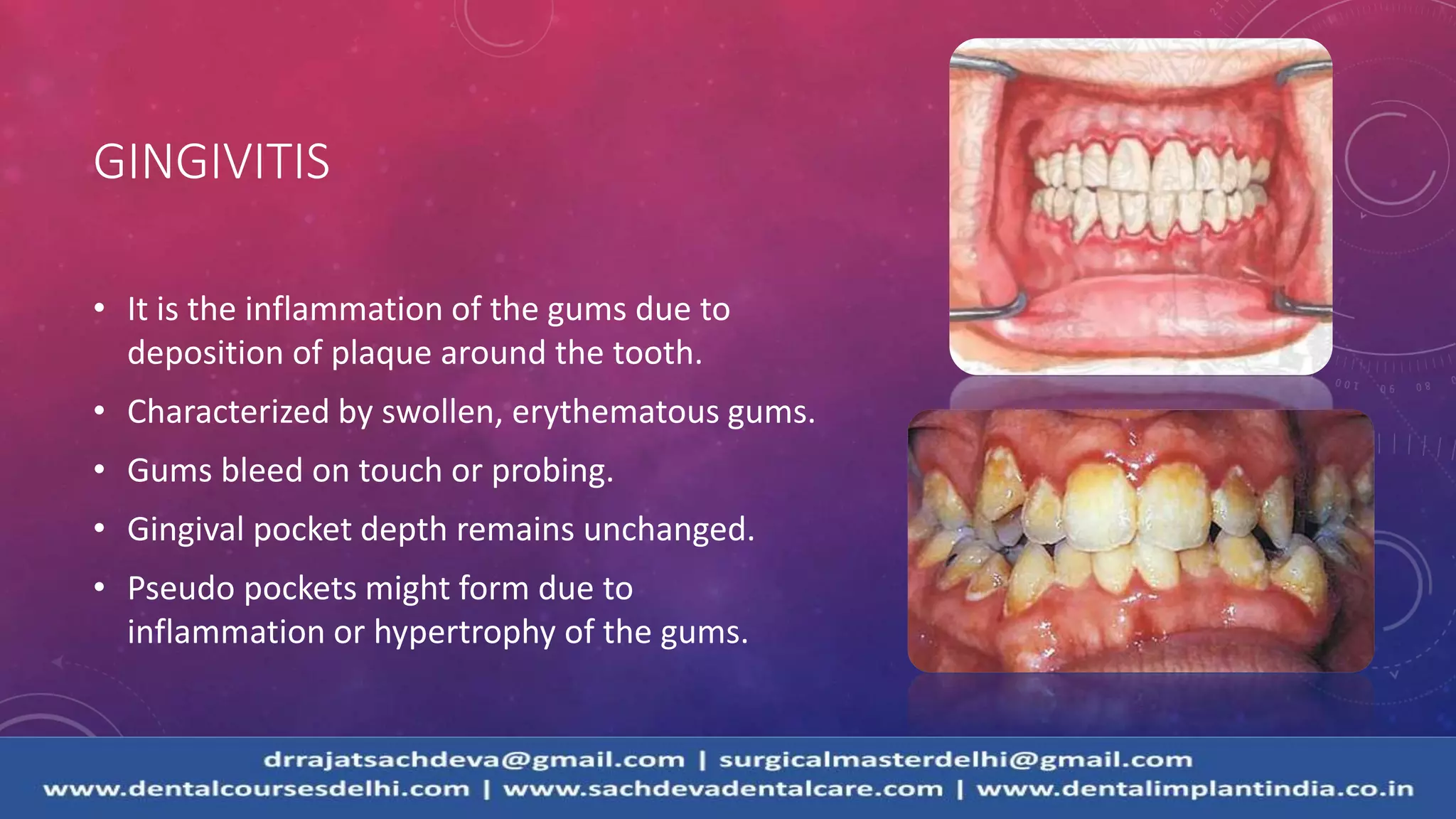 Scaling and root planning | Periodontal treatment protocol | Treatment ...