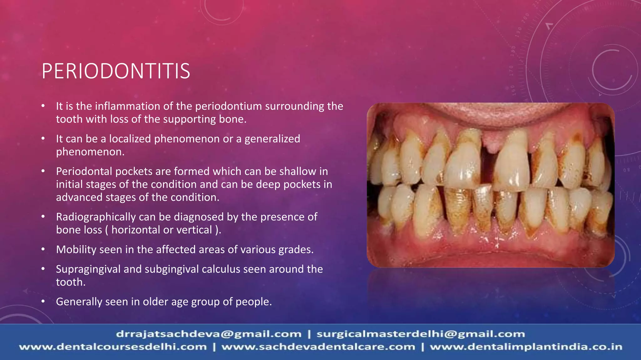 Scaling and root planning | Periodontal treatment protocol | Treatment ...