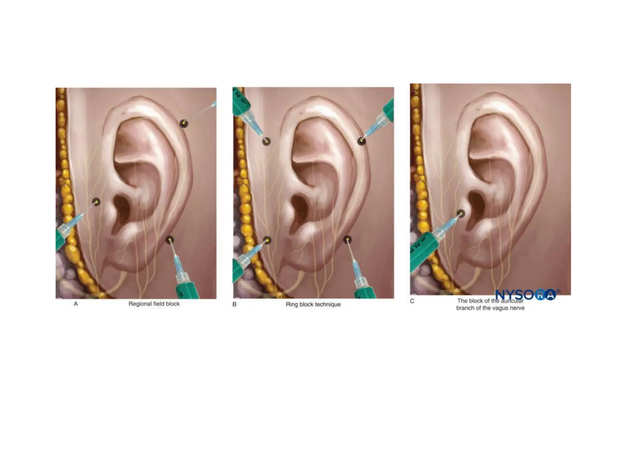 SCALP Block scalp block scalp block scalp | PPTX