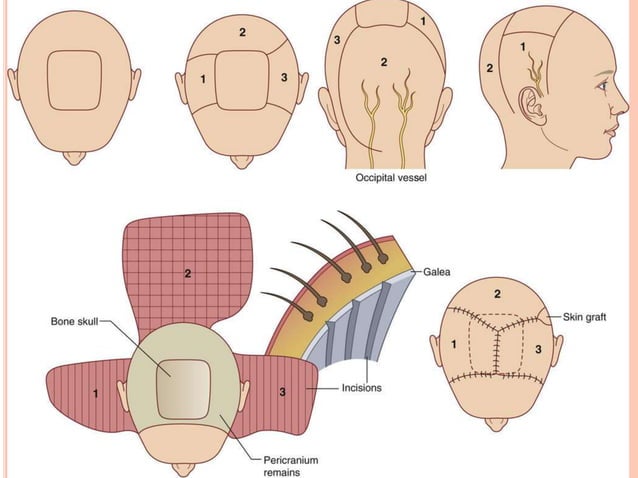 Scalp defects | PPTX
