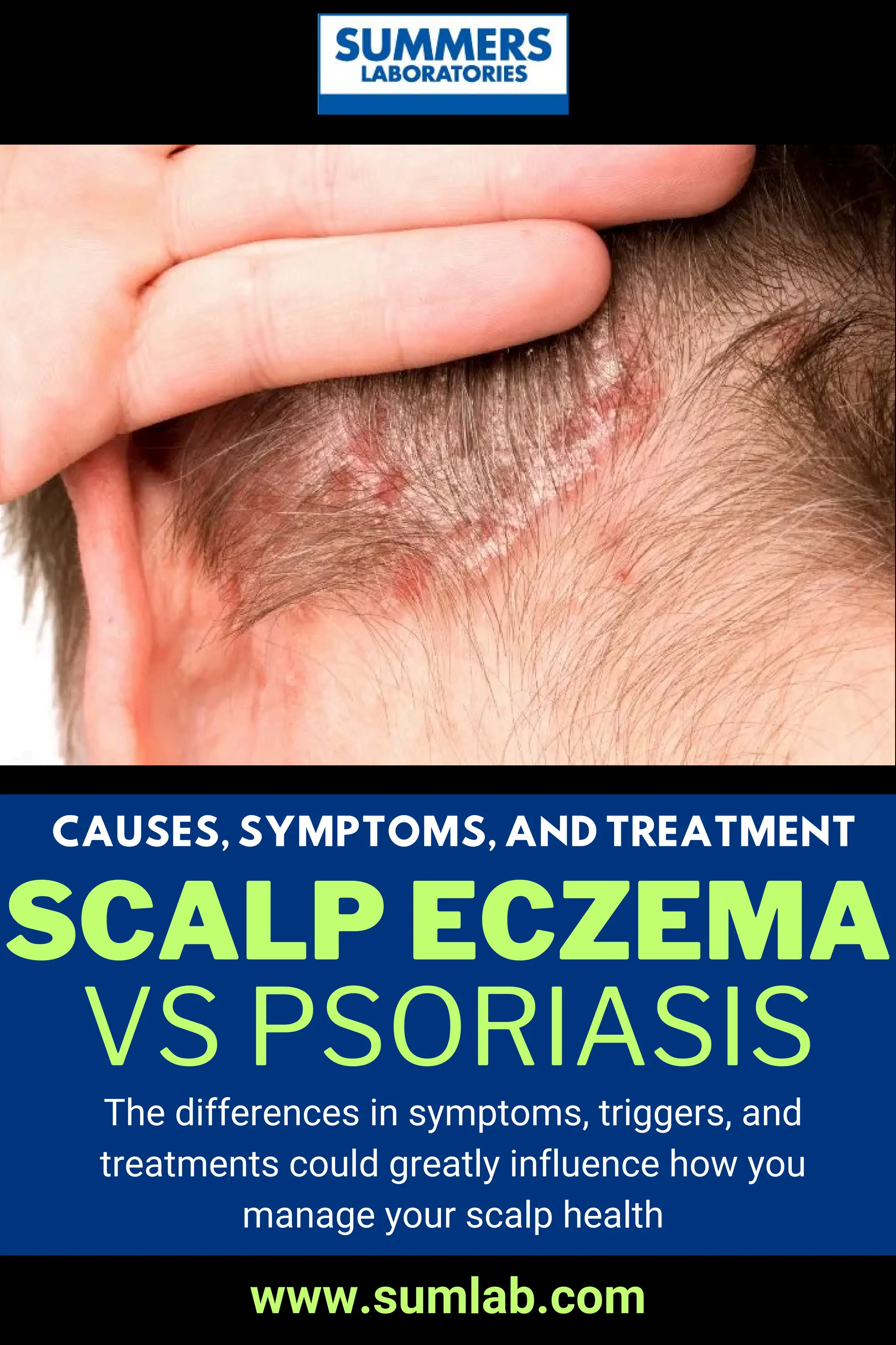 What are the best treatment options for scalp eczema and psoriasis? | PDF