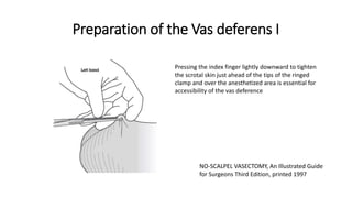 Scalpelless Vasectomy by Dr Dirk Grothuesmann | PPT