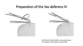 Scalpelless Vasectomy by Dr Dirk Grothuesmann | PPTX