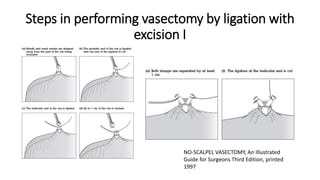 Scalpelless Vasectomy by Dr Dirk Grothuesmann | PPTX
