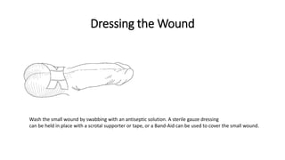 Scalpelless Vasectomy by Dr Dirk Grothuesmann | PPTX