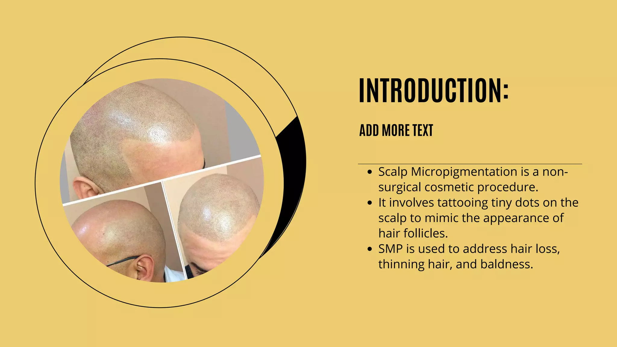 Scalp Micropigmentation (SMP) | Hair Tattoo | PDF