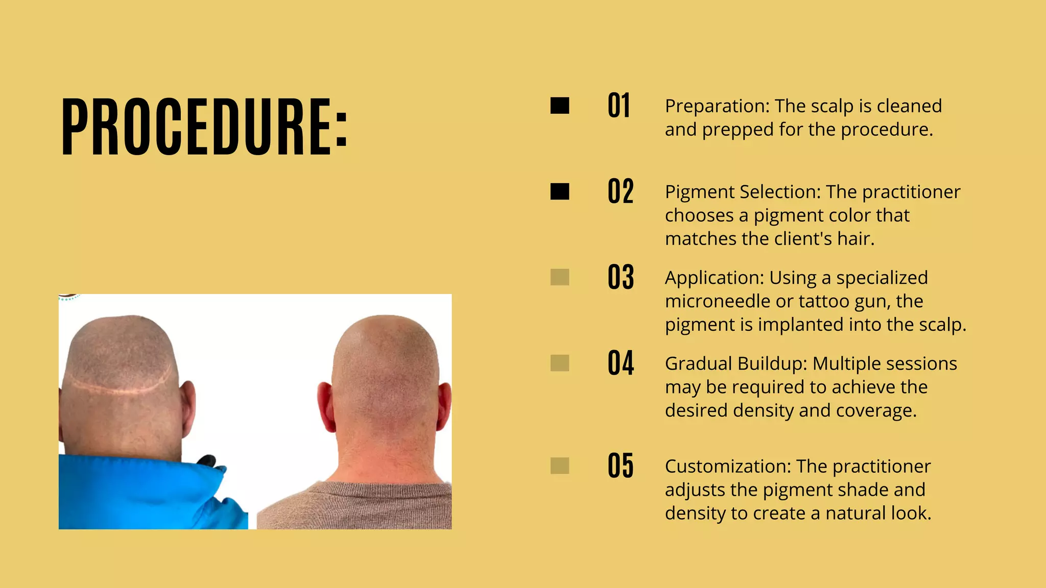 Scalp Micropigmentation (SMP) | Hair Tattoo | PDF