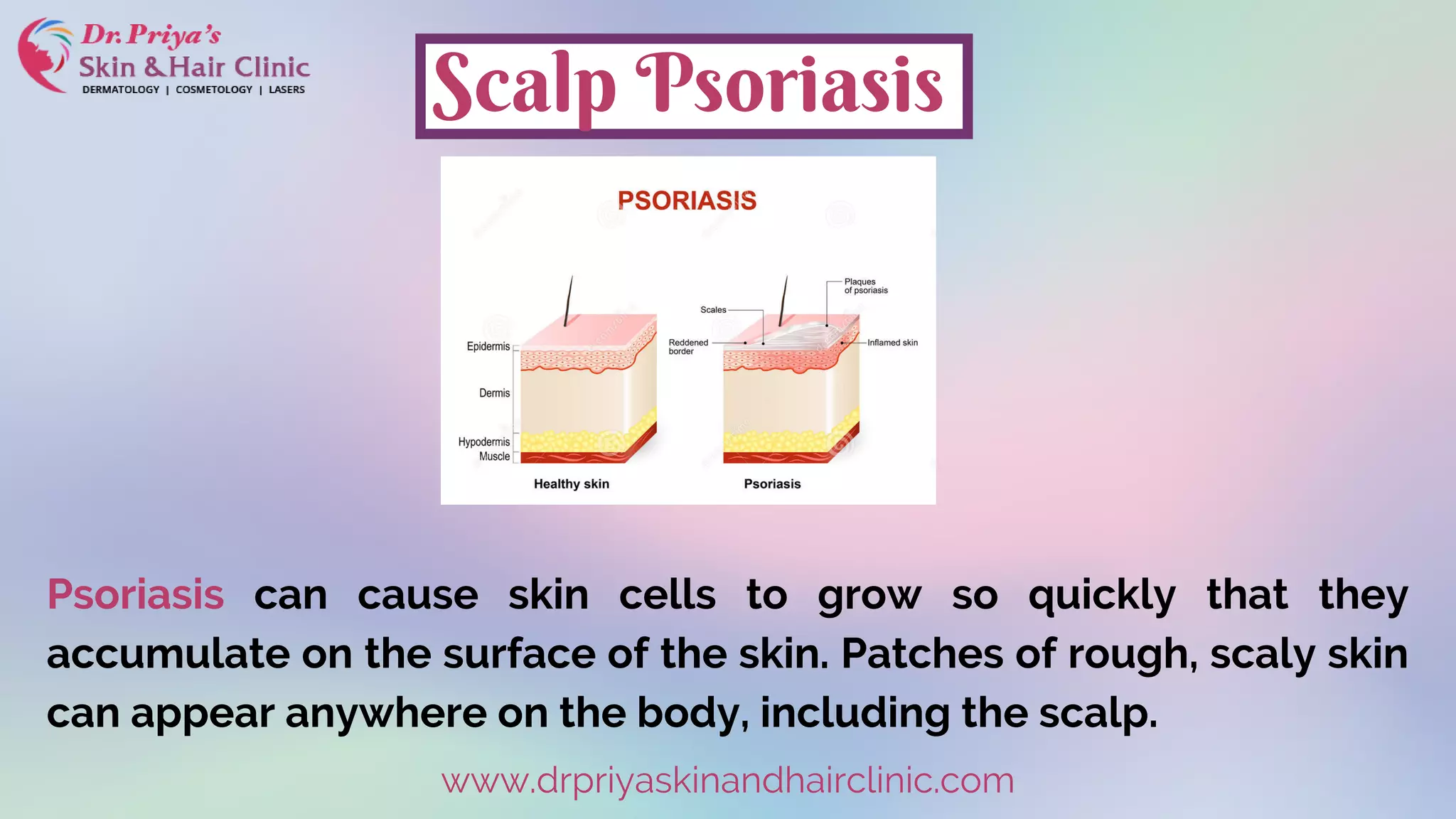 Scalp Psoriasis Vs Seborrheic Dermatitis | PDF