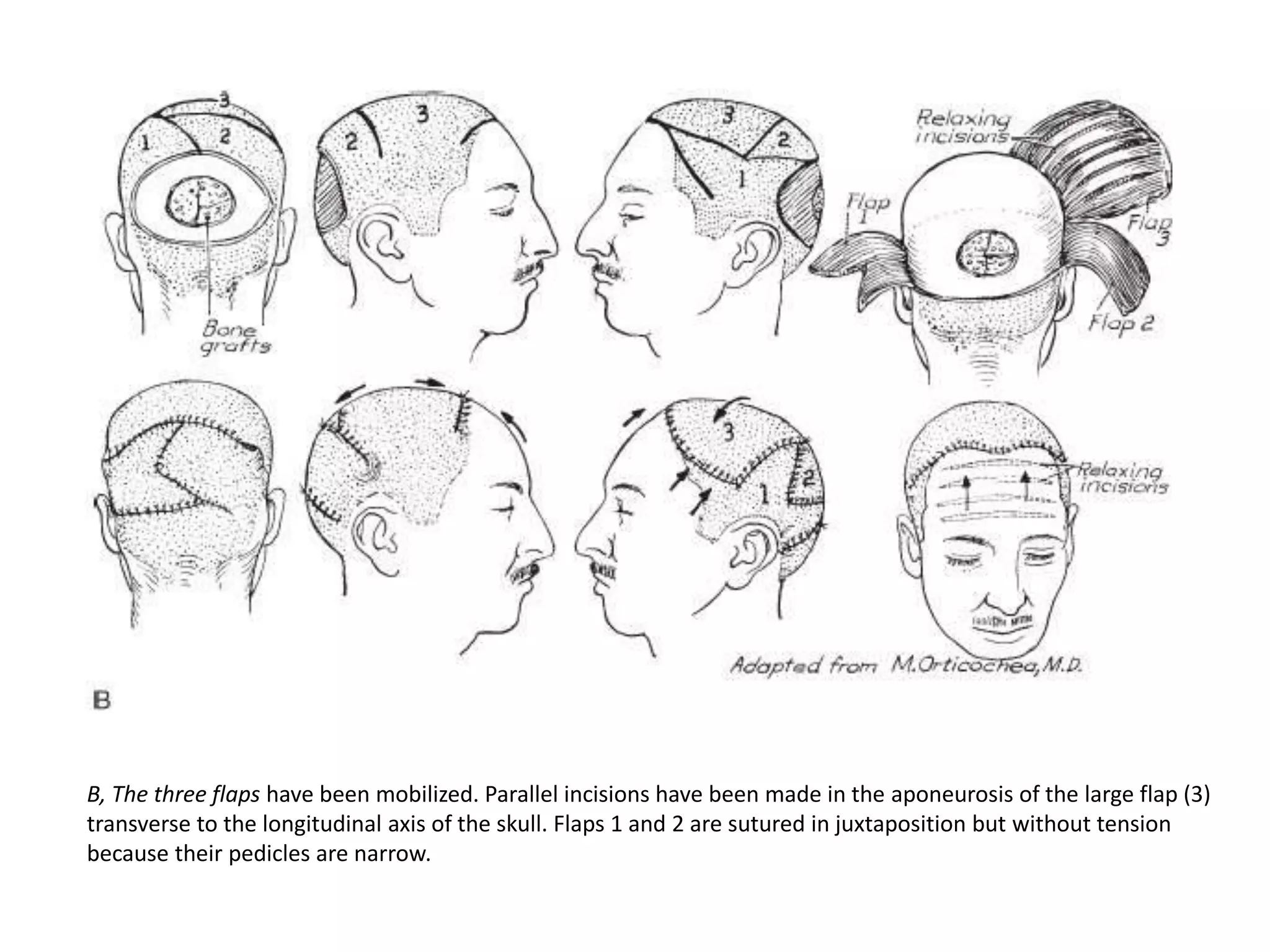 Scalp reconstruction | PPTX