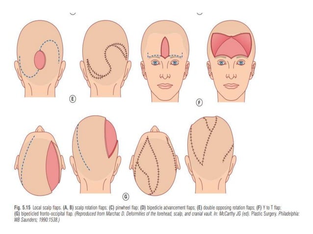 Scalp reconstruction | PPTX