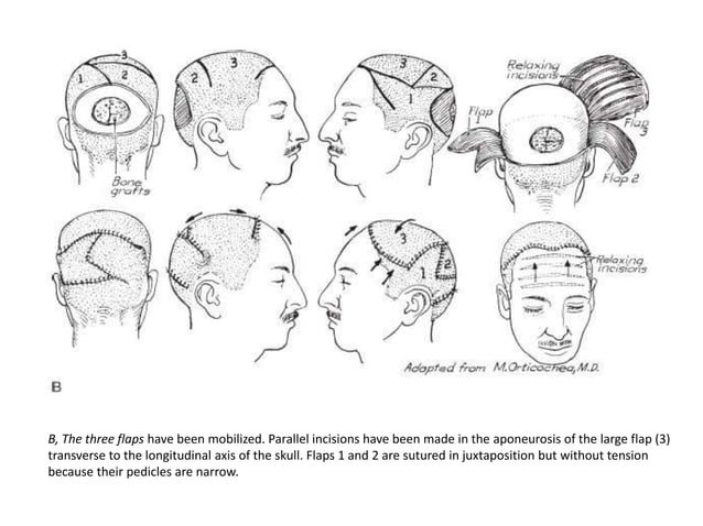 Scalp reconstruction | PPTX