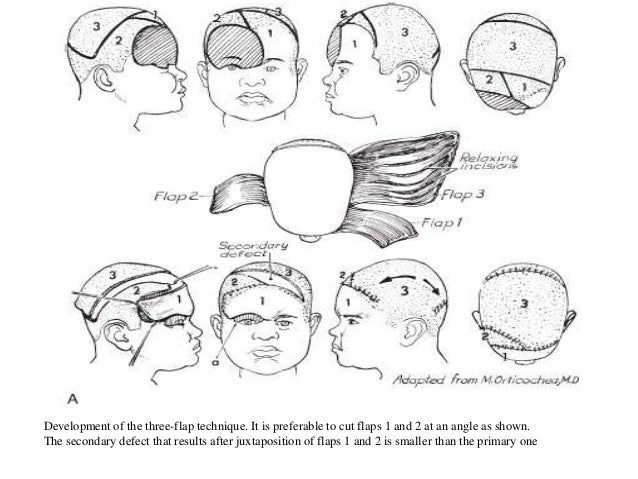 Forehead Scalp Reconstruction Calvarium Blood Supply Figure Sketch ...