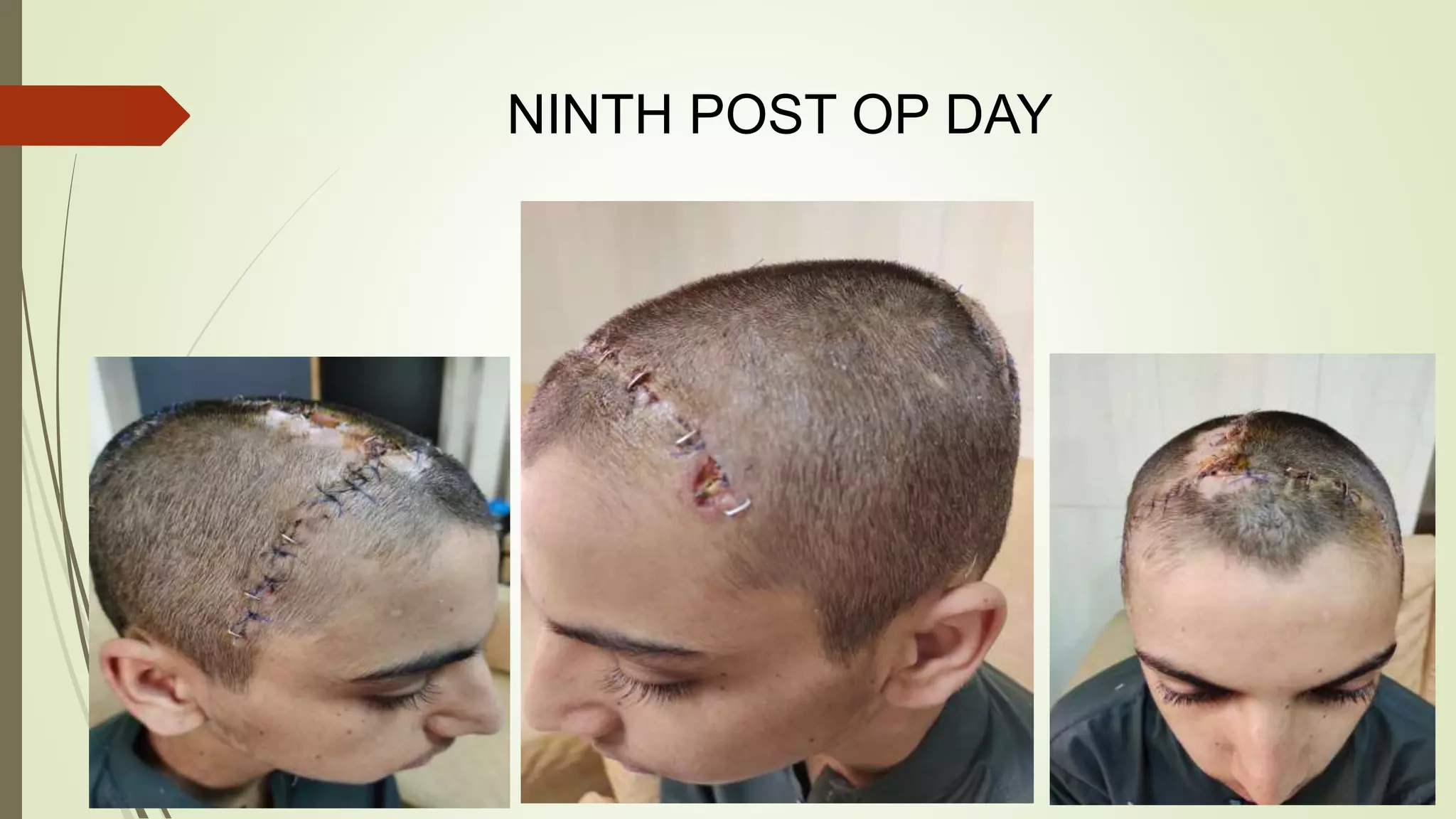 Ortichochea three flap scalp reconstruction by Dr Ali Mujtaba | PPTX
