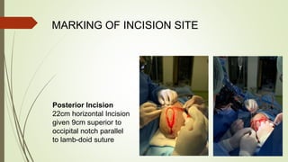 Ortichochea three flap scalp reconstruction by Dr Ali Mujtaba | PPTX