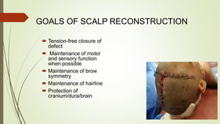 Ortichochea three flap scalp reconstruction by Dr Ali Mujtaba | PPTX