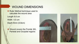 Ortichochea three flap scalp reconstruction by Dr Ali Mujtaba | PPTX