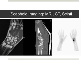 Scaphoid - Tips to fix Scaphoid fractures & Non union management | PPTX