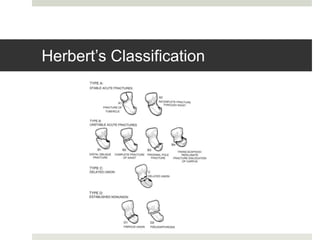 Scaphoid - Tips to fix Scaphoid fractures & Non union management | PPT