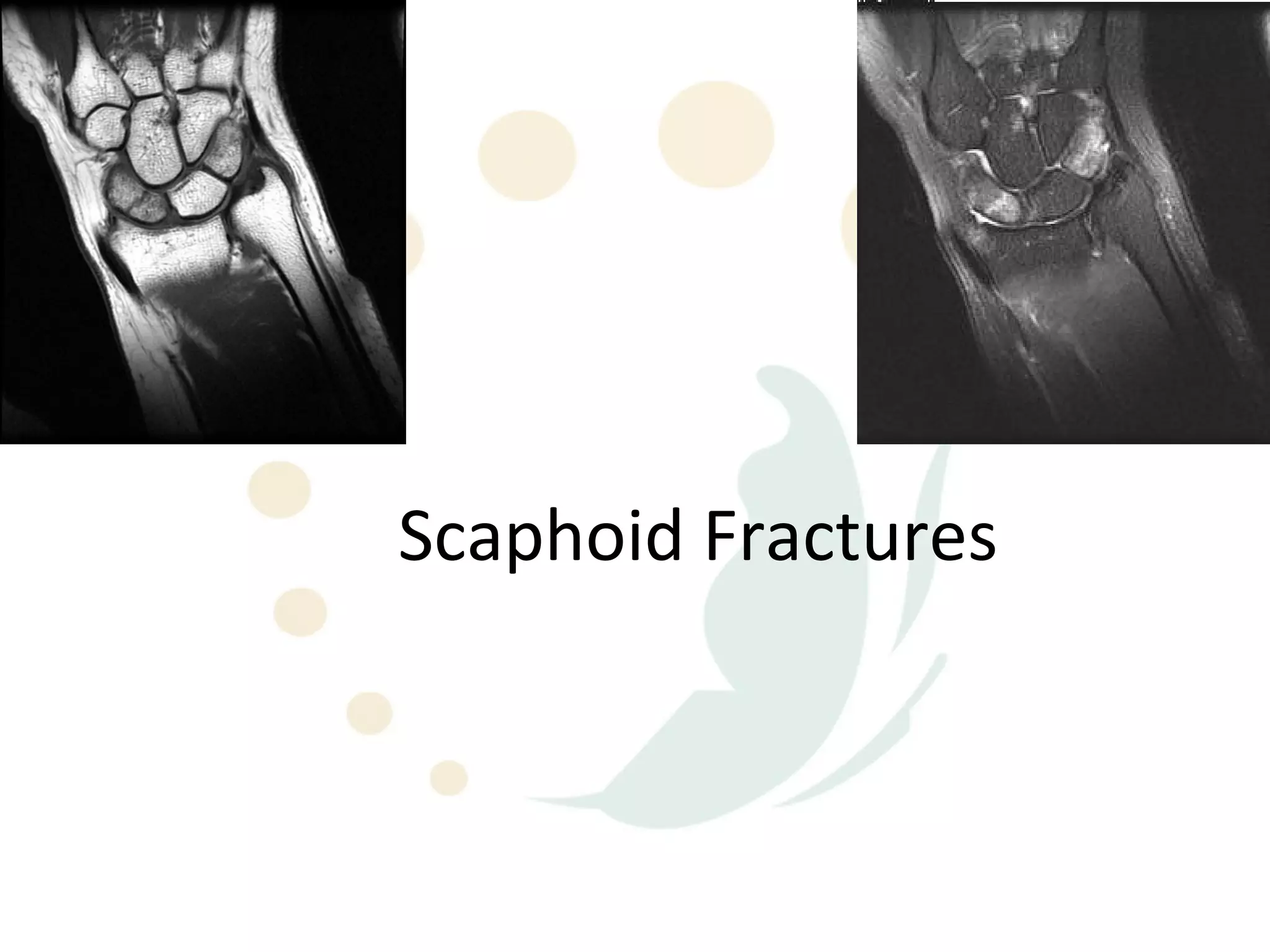 Scaphoid fractures | PPT