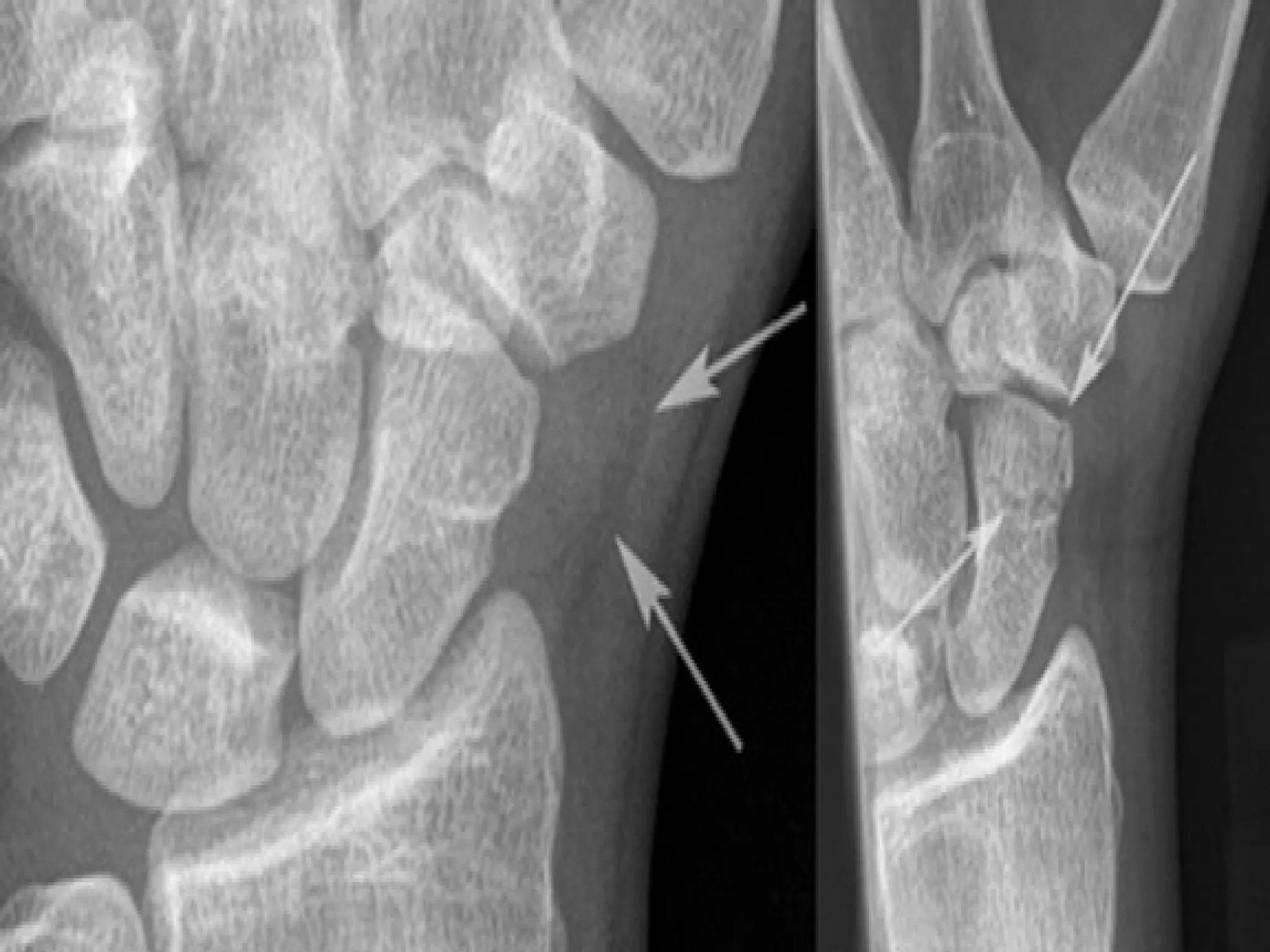 Scaphoid fractures | PPT