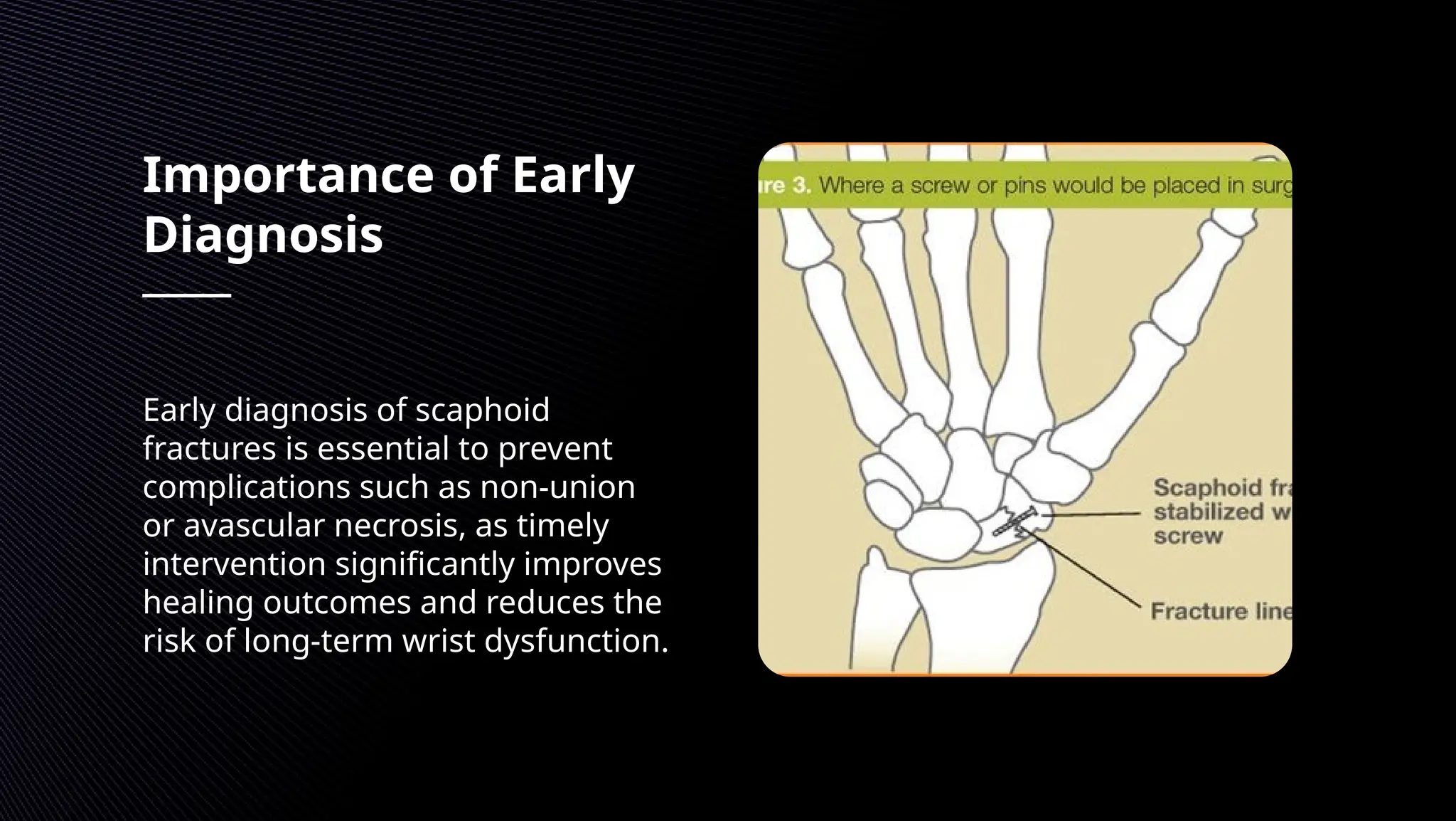 Scaphoid Fracture overview - Understanding and treatment | PPT