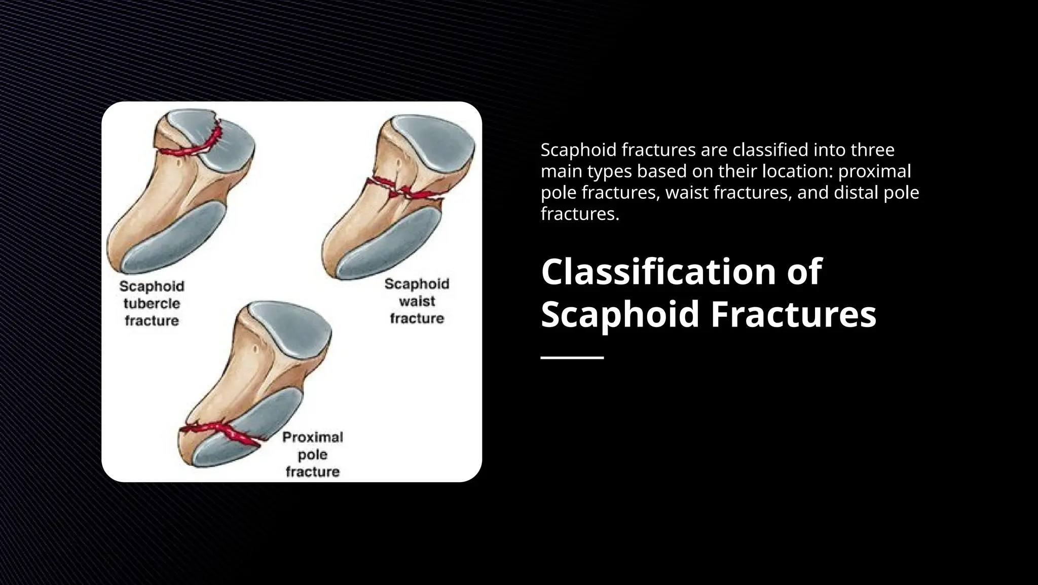 Scaphoid Fracture overview - Understanding and treatment | PPT