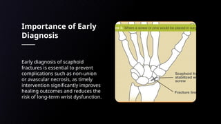 Scaphoid Fracture overview - Understanding and treatment | PPTX
