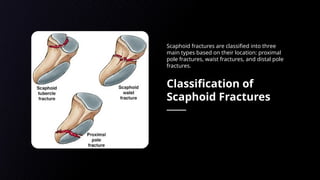 Scaphoid Fracture overview - Understanding and treatment | PPT