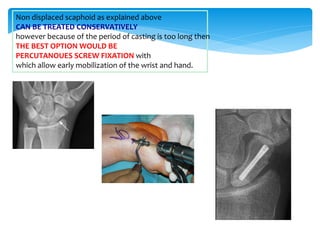 Scaphoid Fracture-RS.wjebndvuieboviewpdf | PDF