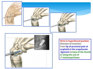 Scaphoid Fracture-RS.wjebndvuieboviewpdf | PPT