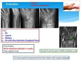 Scaphoid Fracture-RS.wjebndvuieboviewpdf | PPT