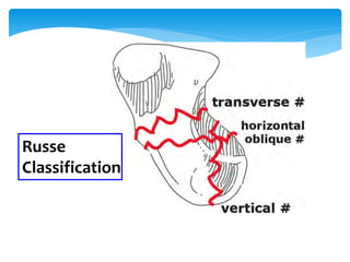 Scaphoid Fracture-RS.wjebndvuieboviewpdf | PPT