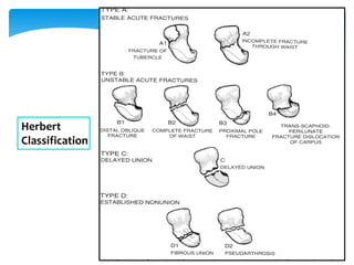 Scaphoid Fracture-RS.wjebndvuieboviewpdf | PPT
