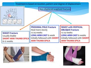 Scaphoid Fracture-RS.wjebndvuieboviewpdf | PDF