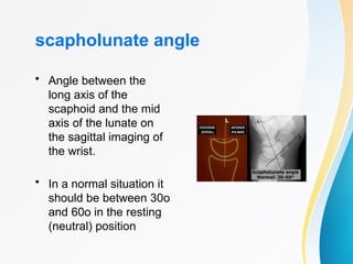 scaphoid FRACTURE(1).pptxccccccccccccccc | PPTX