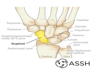 Scaphoid fracture (2) | PPT