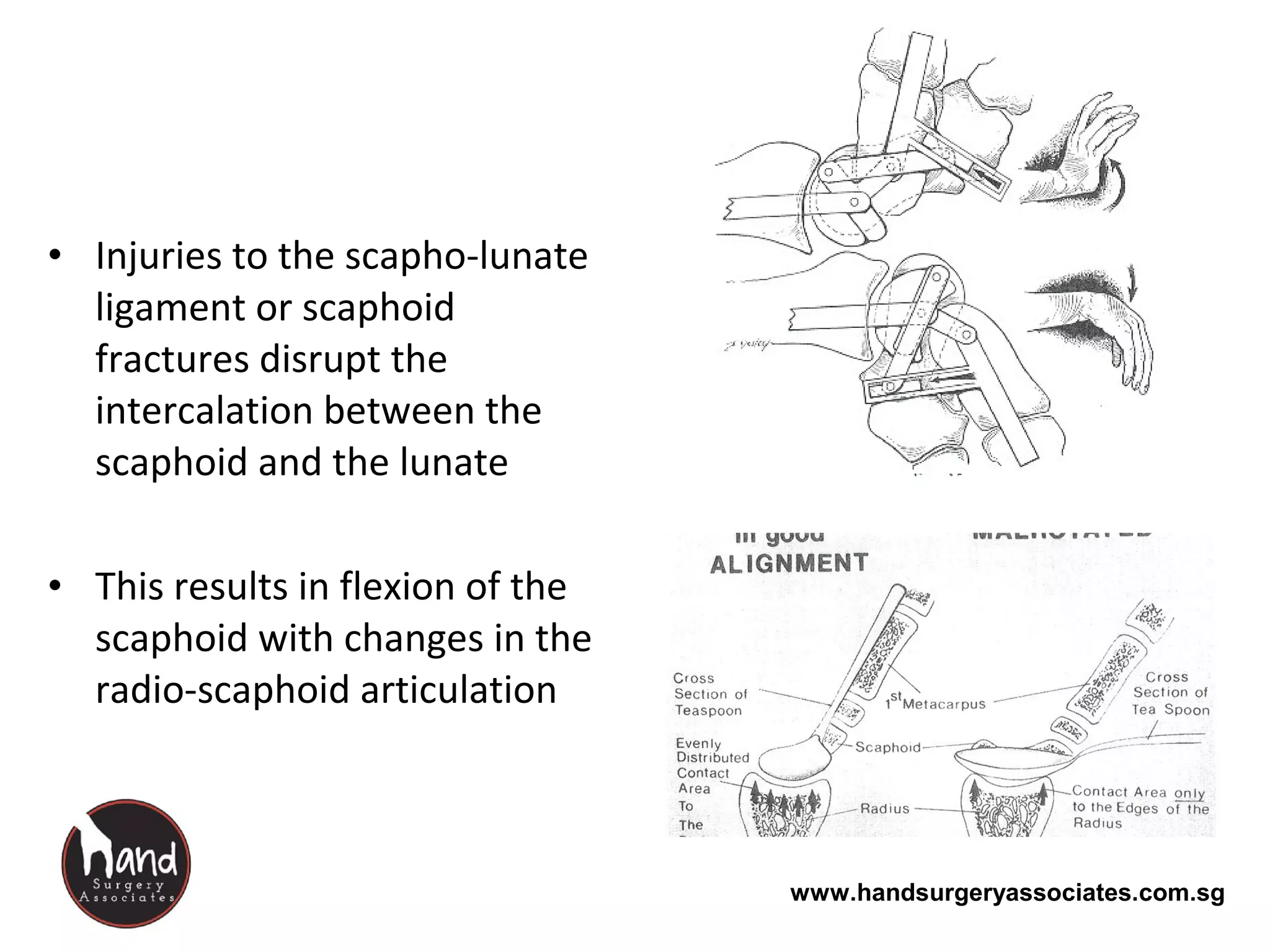 Scaphoid fracture and hcs | PPT