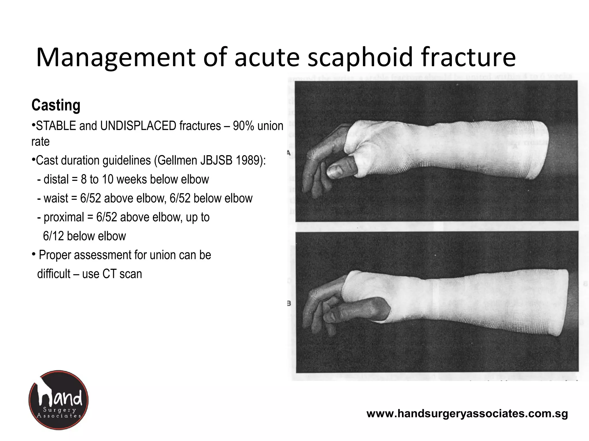Scaphoid fracture and hcs | PPT