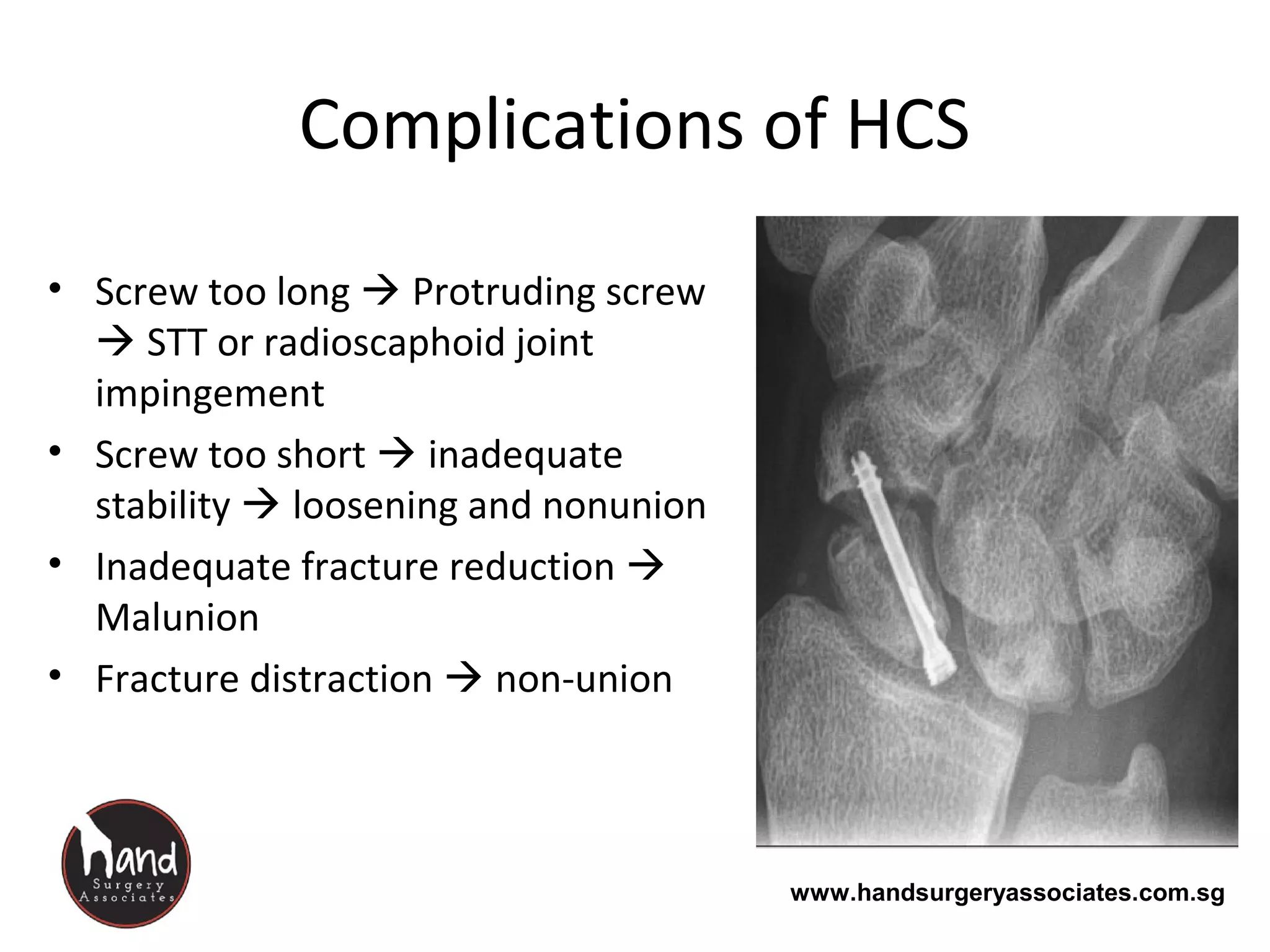 Scaphoid fracture and hcs | PPT