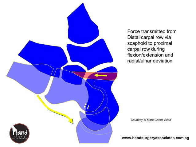 Scaphoid fracture and hcs | PPT