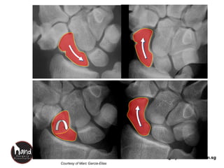 Scaphoid fracture and hcs | PPT