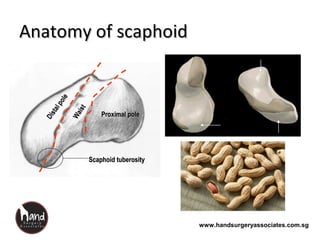Scaphoid fracture and hcs | PPT