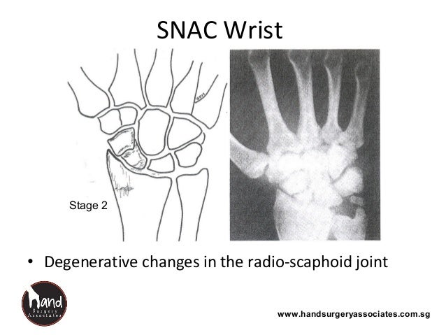 Scaphoid fracture and hcs