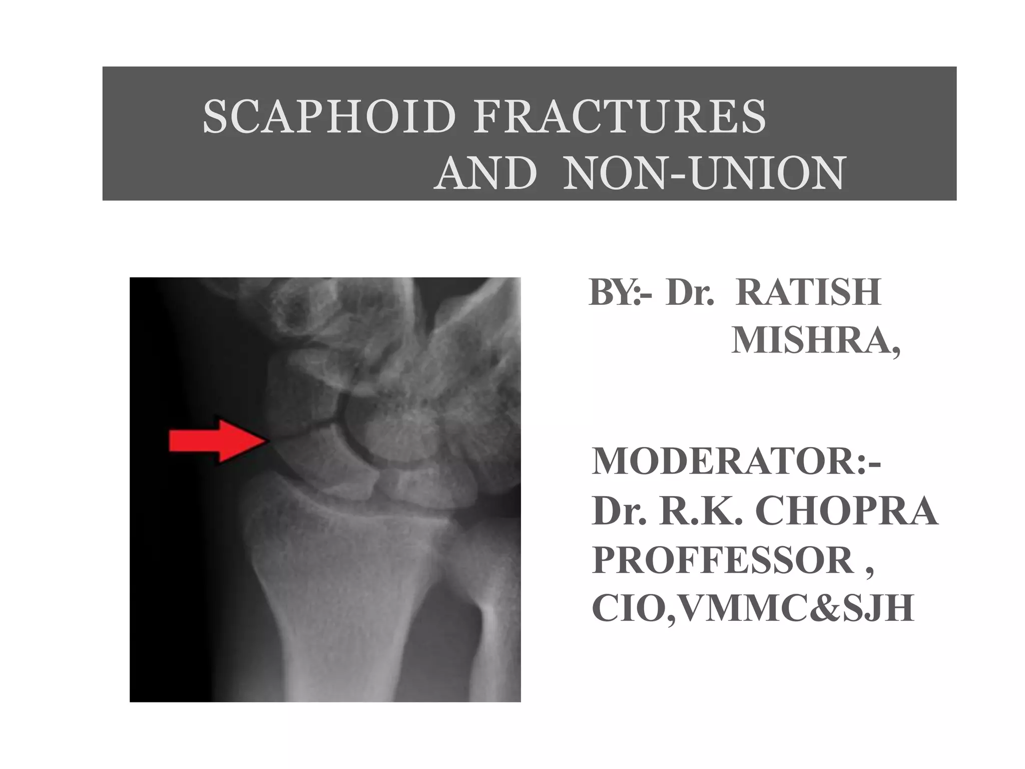 Scaphoid fracture and non union | PPTX
