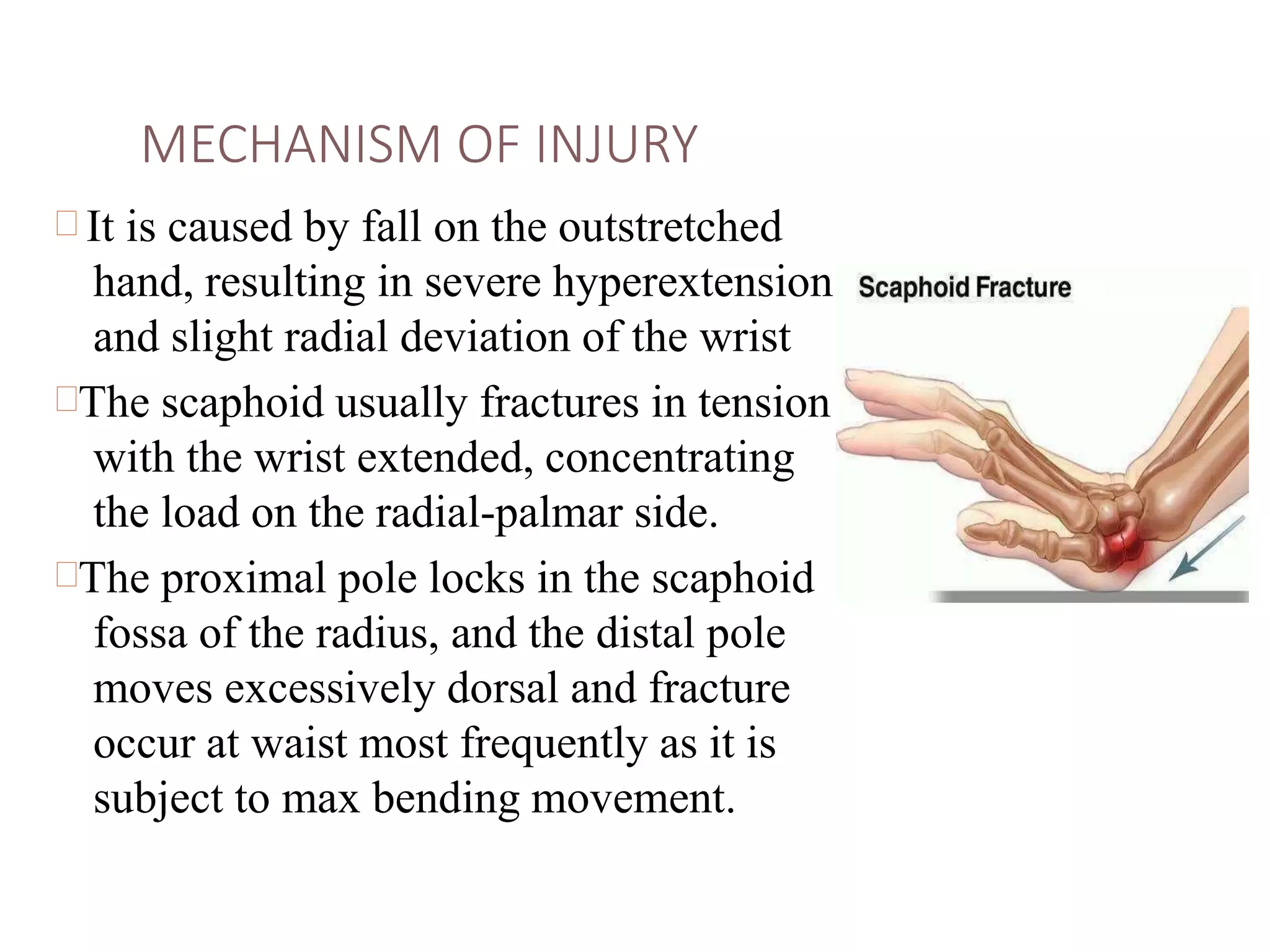 Scaphoid fracture and non union | PPTX