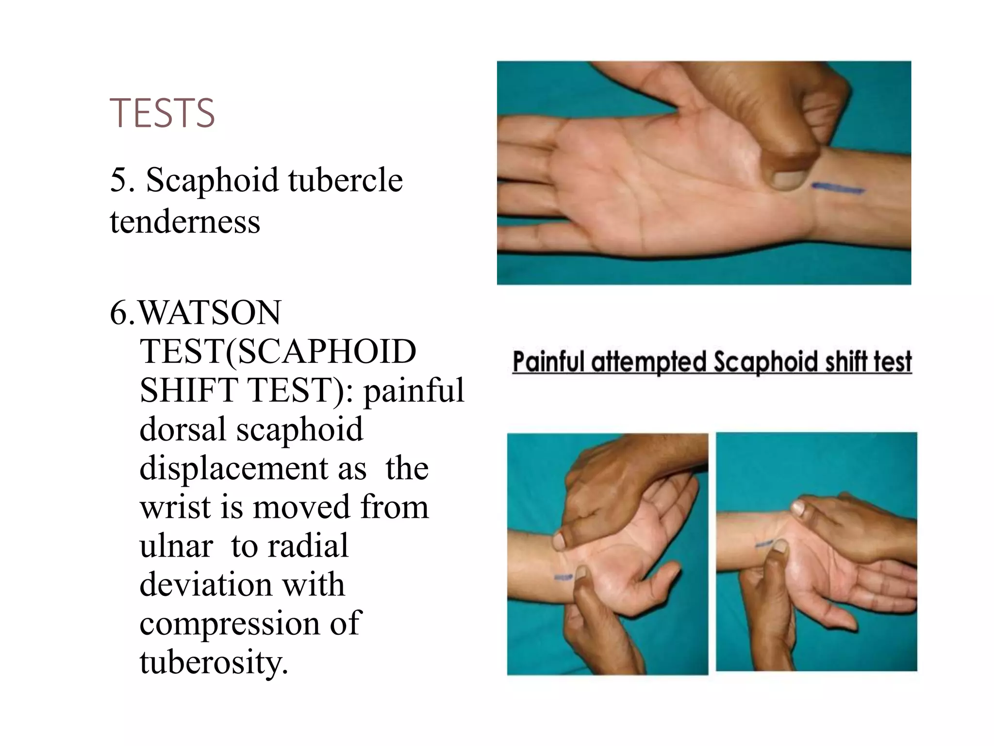 Scaphoid fracture and non union | PPTX