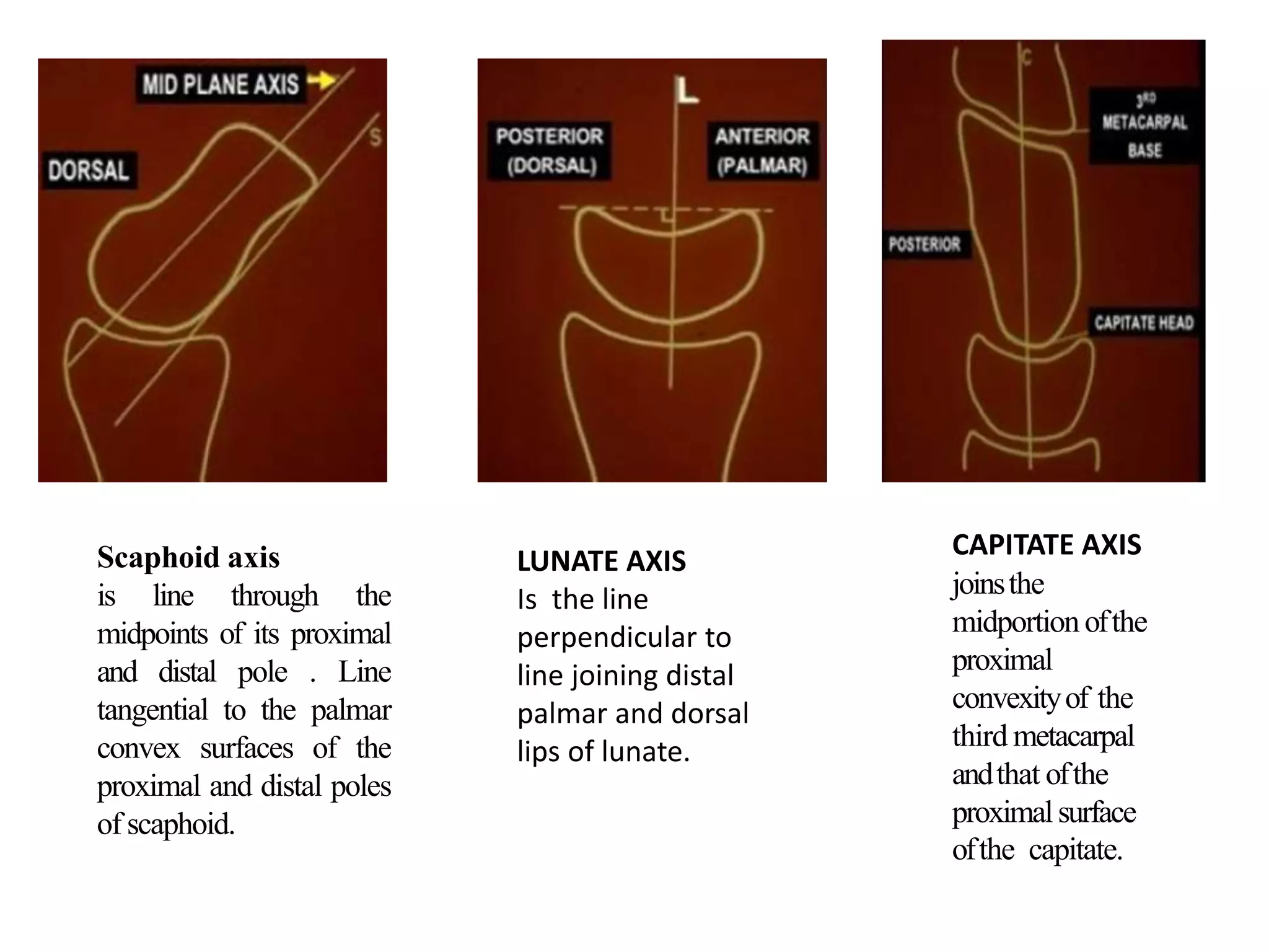 Scaphoid fracture and non union | PPTX